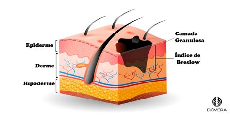 O Que é índice De Breslow