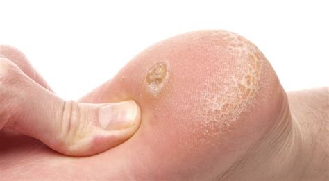 ფეხისგულების კანზე კოჟრებისა და ბზარების არსებობამ რომ არ შეგაწუხოთ გამოიყენეთ ხელმისაწვდომი