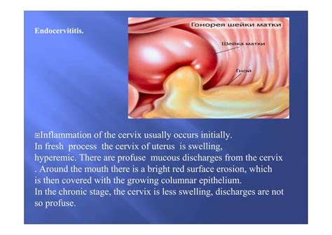 Gonorrhea Ppt