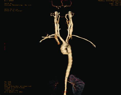 Ct Aortogram Showing Long Segment Circumferential Narrowing Of