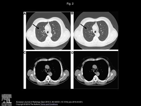 Low Dose Chest Ct Protocol 50mas As A Routine Protocol For