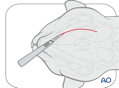 Ventral Approach To Mandibular Body