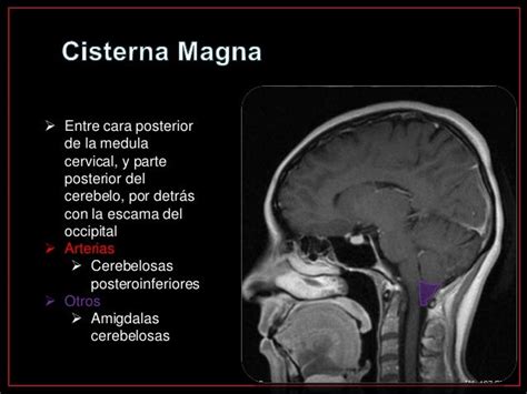 Cisternas Cerebrales