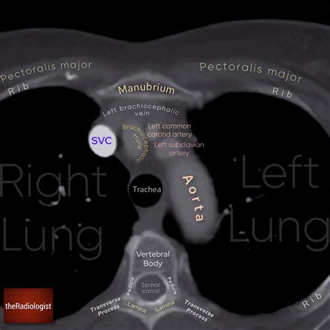 Heart Ct Scan Labeled