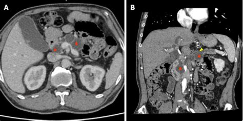 Laparoscopic spleen-preserving total pancreatectomy for the treatment of low-grade malignant ...