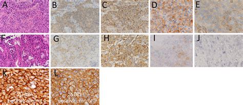 Figure2 Pathological Findings In A High Power Field 400 Fold