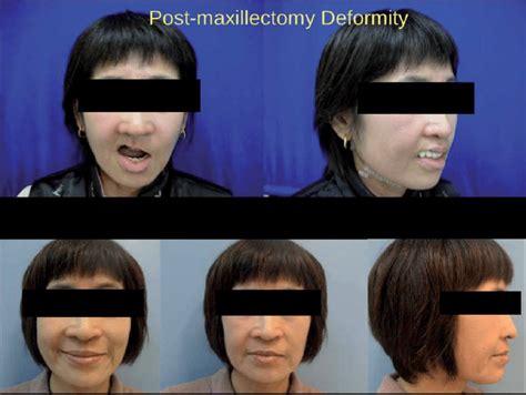 Significant Deformity After Right Maxillectomy For Cancer Download Scientific Diagram
