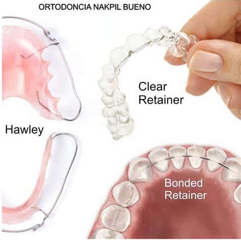 Ada Code Removable Retainer At Paul Nichols Blog