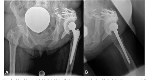 Figure 1 From An Alternative Treatment Option For Paprosky Type Iiib