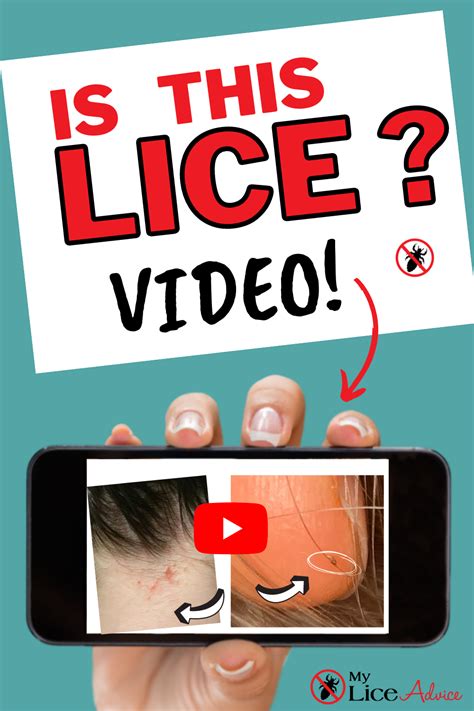 Lice But No Nits Video Tutorial Artofit