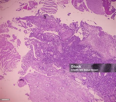 신장암 신장 세포 암종의 가장 흔한 유형인 신장의 전이성 투명 세포 암종의 현미경 이미지 악성 신 생물의 뇌 조직 큰 비정형 기괴한 세포를 보여줍니다 건강관리와 의술에 대한