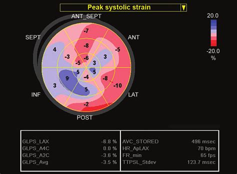 Bulls Eye Of Global Longitudinal Strain In A Dilated Cardiomyopathy