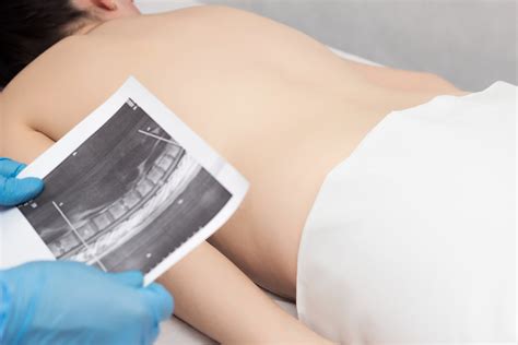 Lumbar Fusion Surgery In Turkey Fusion Surgery Turkey