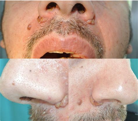 Figure 2 From Secondary Syphilis With Extra Genital Condyloma Lata A Case Report And Review Of
