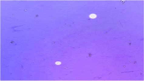 India Ink Stain Of CSF Demonstrating Encapsulated Yeast Like Fungus Download Scientific