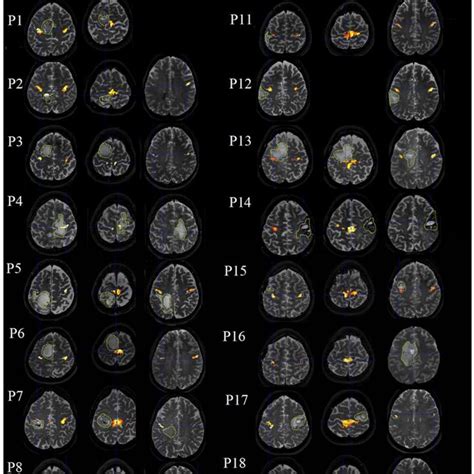 Upper Mni Coordinates Of Peak Activations For Mouth And Hand Region Download Scientific