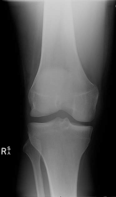 Sulcus Terminalis Femur
