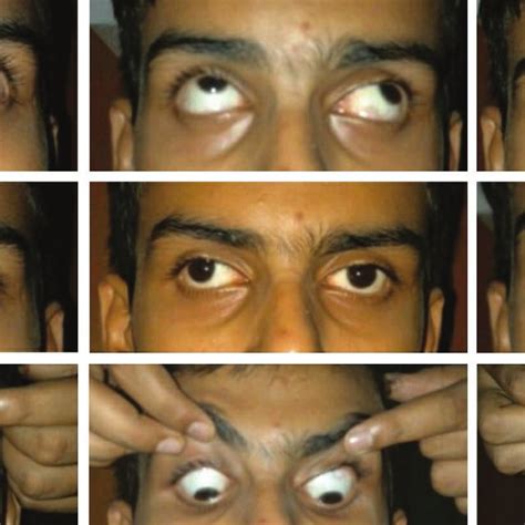 PDF Consecutive Exotropia A Case Report And Review Of Literature
