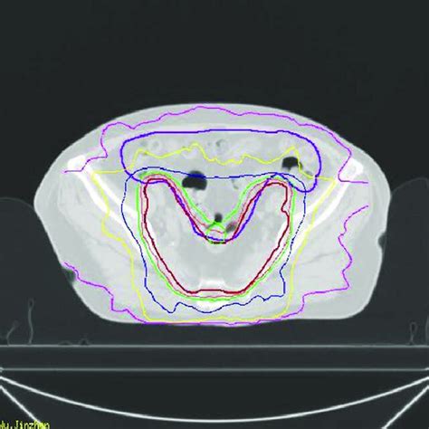 Auto Vmat Plan Isodose Curve Distribution Auto Vmat Automatic