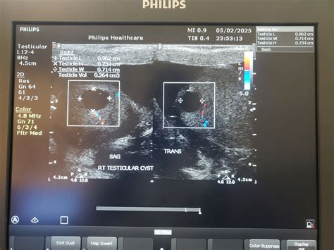 A Case Of Testicular Cyst