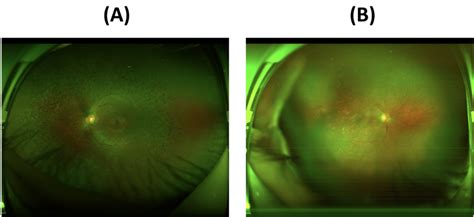 [논문 리뷰] Deep Learning Based Detection Of Referable Diabetic Retinopathy
