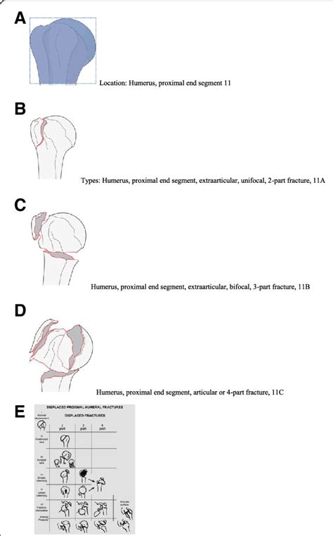 A B C And D Classification Table For Proximal Humerus Fractures Download Scientific Diagram