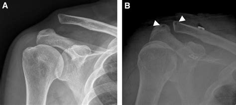 A Preoperative Simple Radiography Shows Rockwood Classification Type