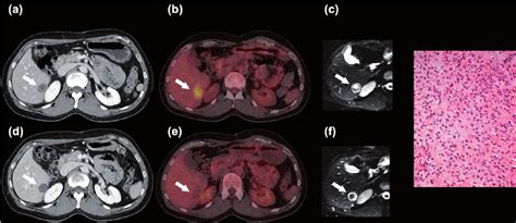 Forty One Year Old Man With Metastatic Gist Patient 2 Liver