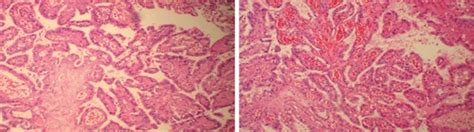 Choroid Plexus Papilloma With Atypical Features There Is Mild To