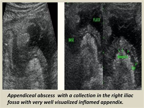 Presentation1 Pptx Ultrasound Examination Of The Appendix Pptx