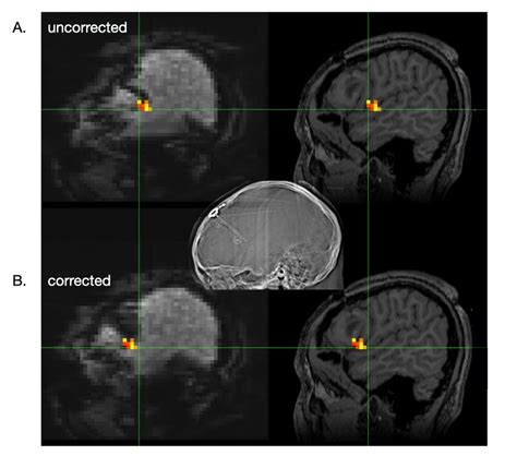 Consensus Recommendations For Clinical Functional Mri Applied To