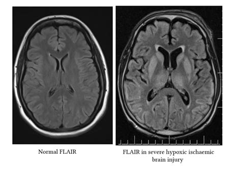 Radiological Findings In Hypoxic Ischaemic Encephalopathy Deranged Physiology