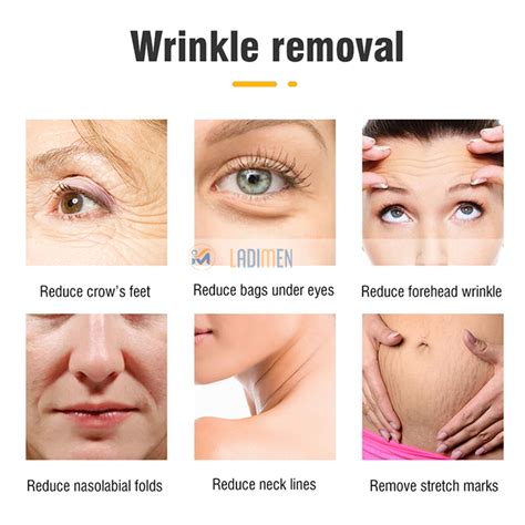 Intensity Focused Ultrasound 4d 8d 12d Hifu Ultramax Cartridge Slimming U Matrix 3d Hifu Machine