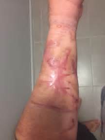 Phalloplasty Arm