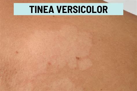 White Spots On Skin 24 Causes Pictures Treatment