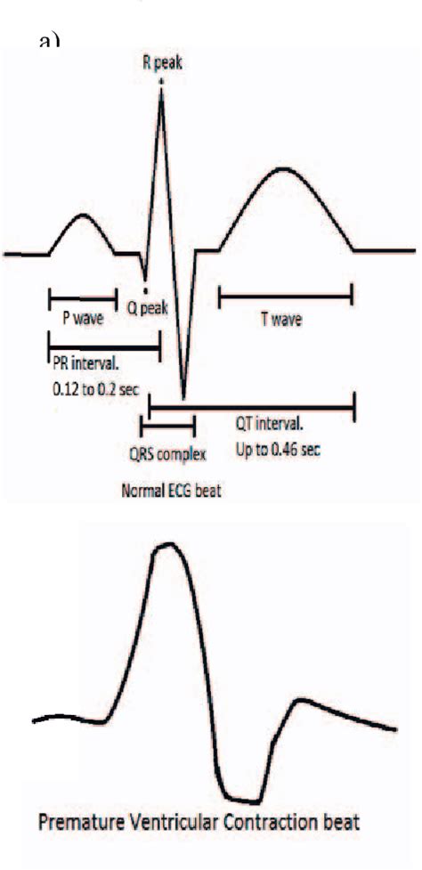 Premature Ventricular Contraction Ecg