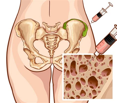 Bone Marrow Examination And Biopsy Shashwat Hemato Onco Associates