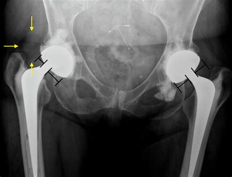 Hip Replacement Dislocation Recovery At John Heidt Blog