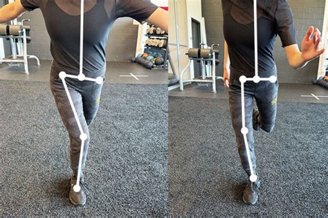 Why Are Acl Tears So Common Among Female Athletes