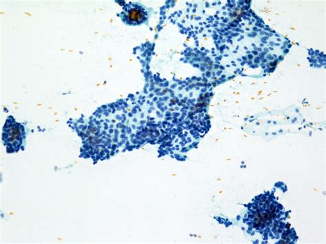 Pathology Outlines Neoplasm Salivary Gland Neoplasm Of Uncertain Malignant Potential Sump