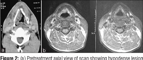 Figure 2 From Idiopathic Primary Supraglottic Laryngeal Abscess Semantic Scholar