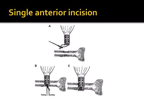 Distal Biceps Tendon Rupture By Hussain Algawahmed Pptx