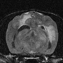 Meningoencephalomyelitis Of Unknown Etiology Mue