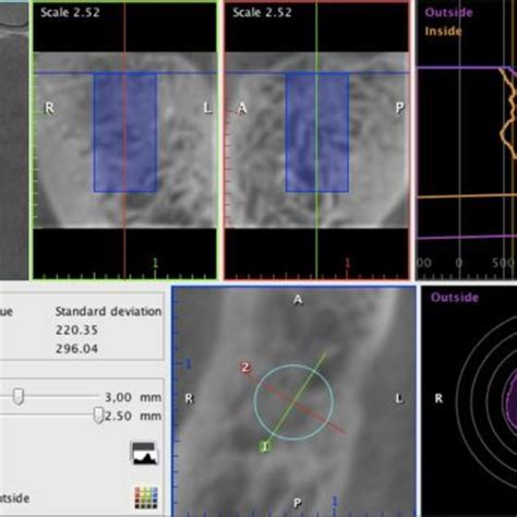 Rtual Implant Site With Mean Bone Density Values In Hounsfield Units