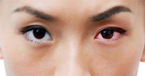 한쪽만 빨개진 눈… 대상포진 신호라고