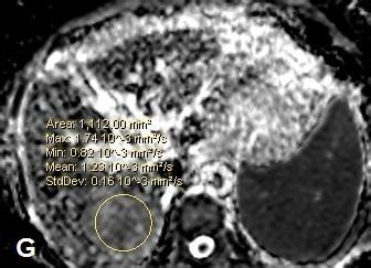 Continued ADC Map With ROI Placed On The Lesion At Segment VII G Download Scientific Diagram