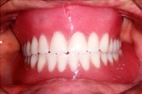 Dentures Suhasya Dental Clinic