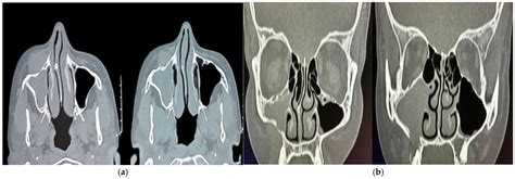 Unmasking The Fungal Menace A Case Report Of Chronic Granulomatous
