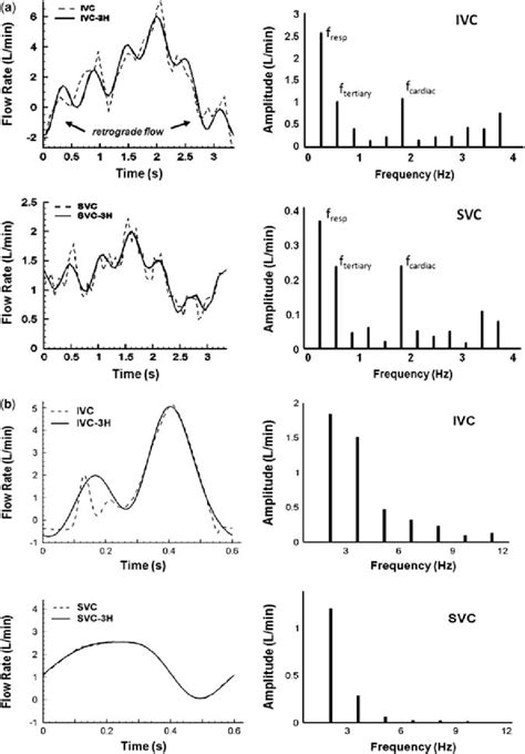 Real Time Venous Flow Waveforms From A Typical Functional Fontan Download Scientific Diagram