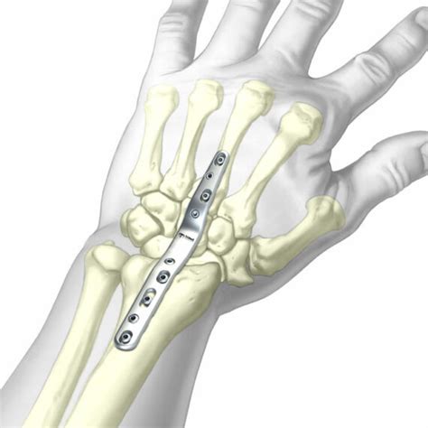 Volar Hook Plate Osteotec